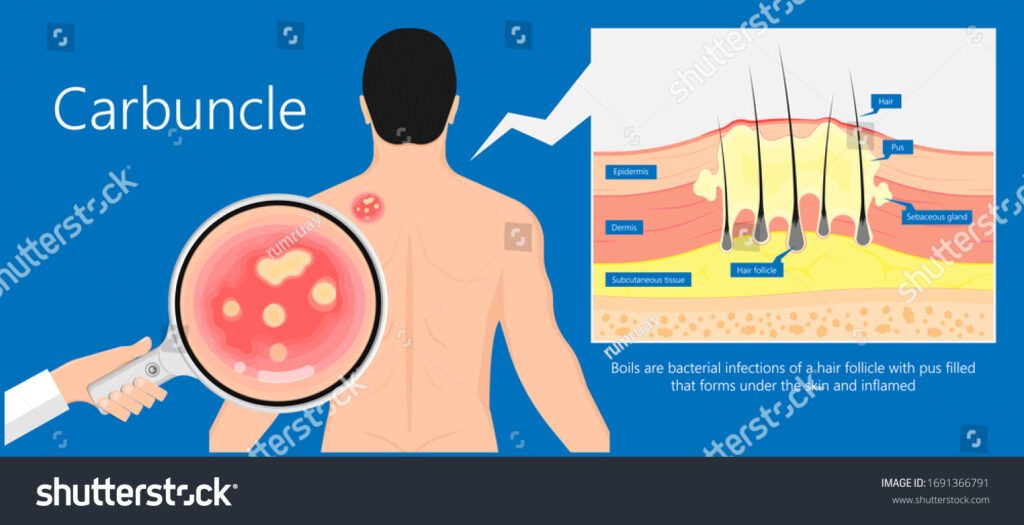 stock-vector-carbuncle-boils-bacterial-infection-under-skin-hair ...